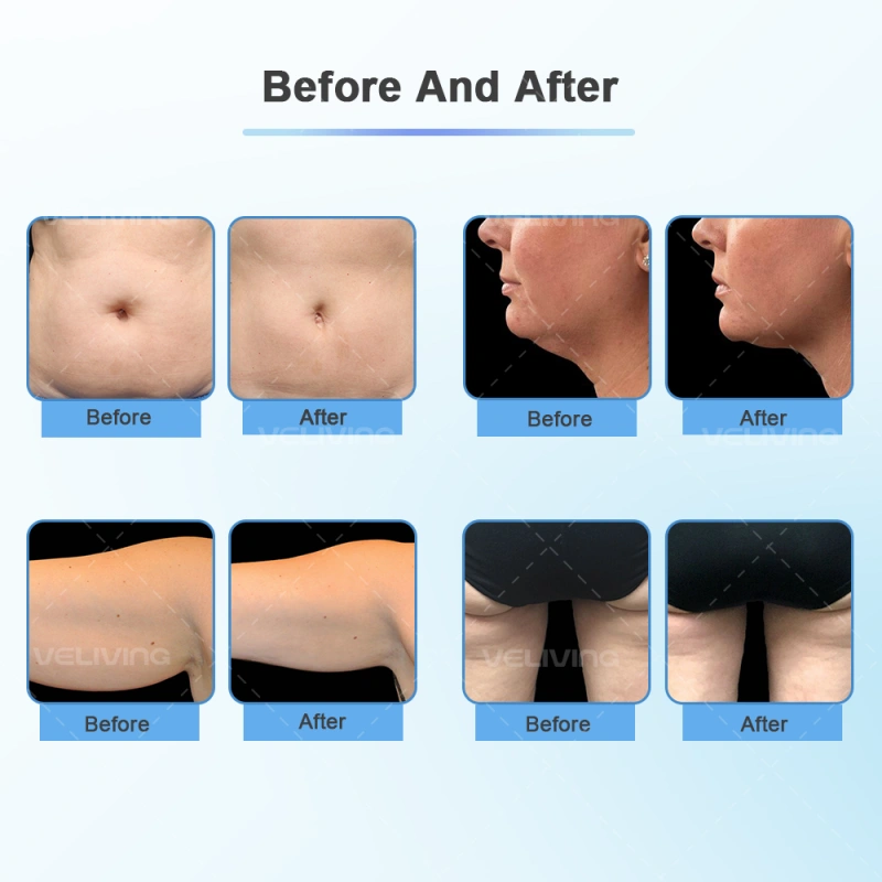 2 In 1 4 Handle 5 Tesla Cryo Body Sculpting Machine Cryolipolysis Fat ...