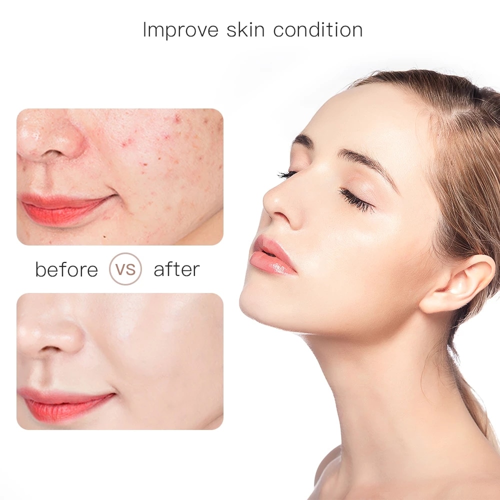 GloPen NP1 Silicon Nano Needling Derma Pen with Rezenerate Tech Micro ...