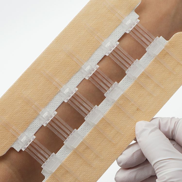 Wound Closure Device Combination Types Skin Color,Wound Closure Device