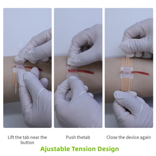 Non-Woven Wound Closure Device Single Type (Skin Color),Wound Closure ...