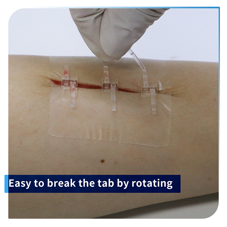 Elastic PU Film Zip Tie Wound Closure Device for Emergency Wound ...