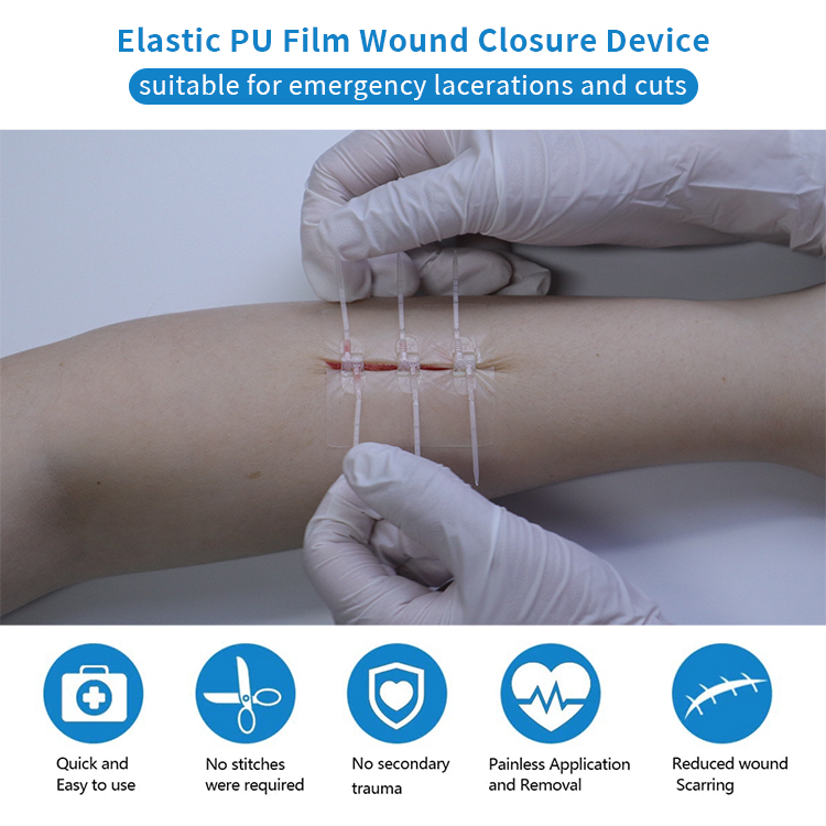 Elastic PU Film Zip Tie Wound Closure Device for Emergency Wound ...