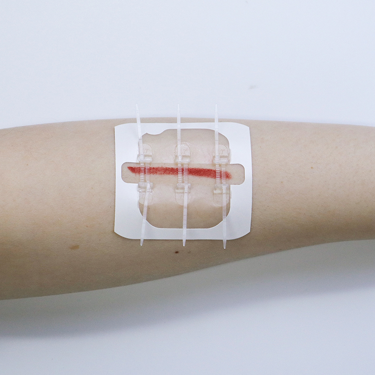 Elastic PU Film Zip Tie Wound Closure Device for Emergency Wound ...