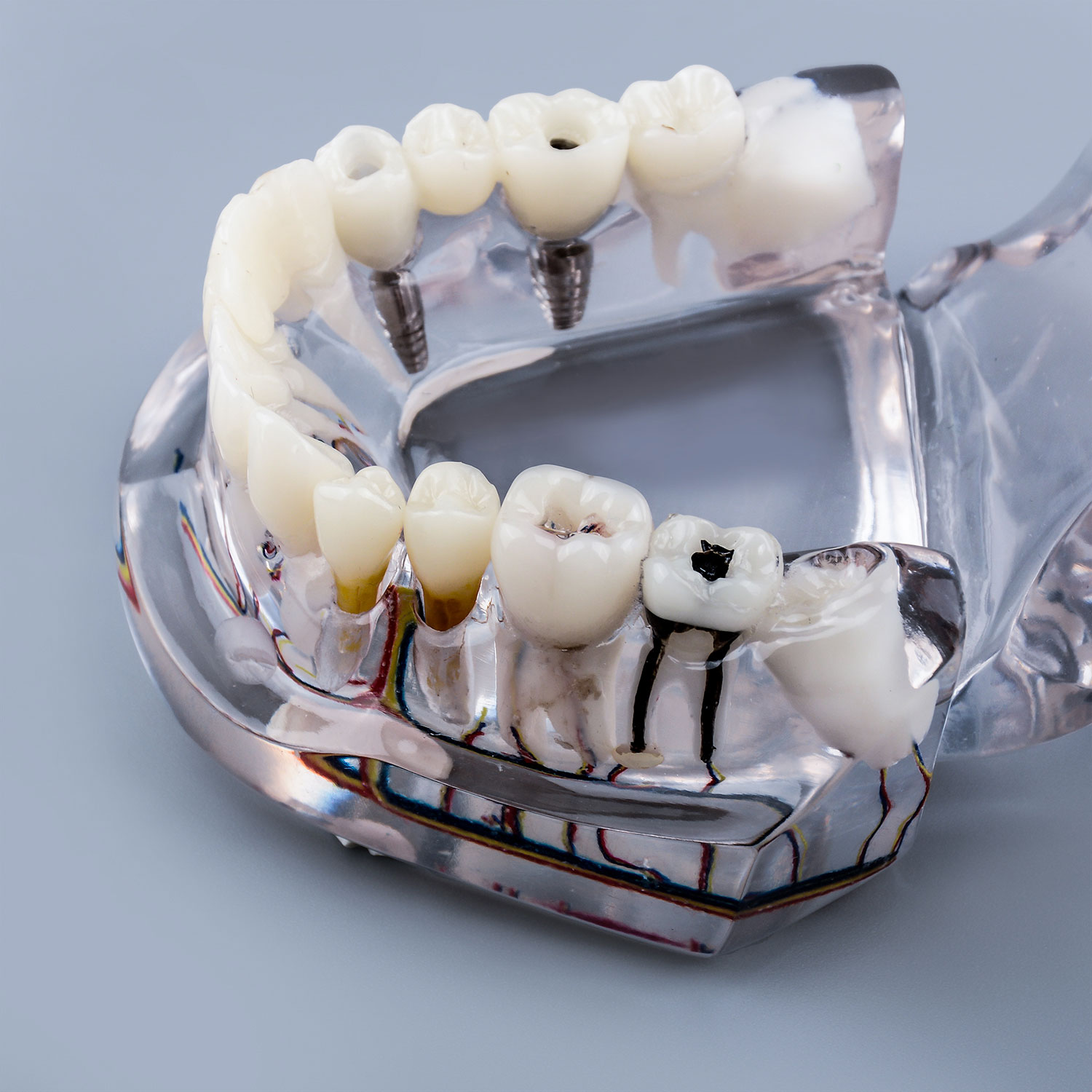 Transparent Pathological Teeth Root Model with Dental Implantsor ...
