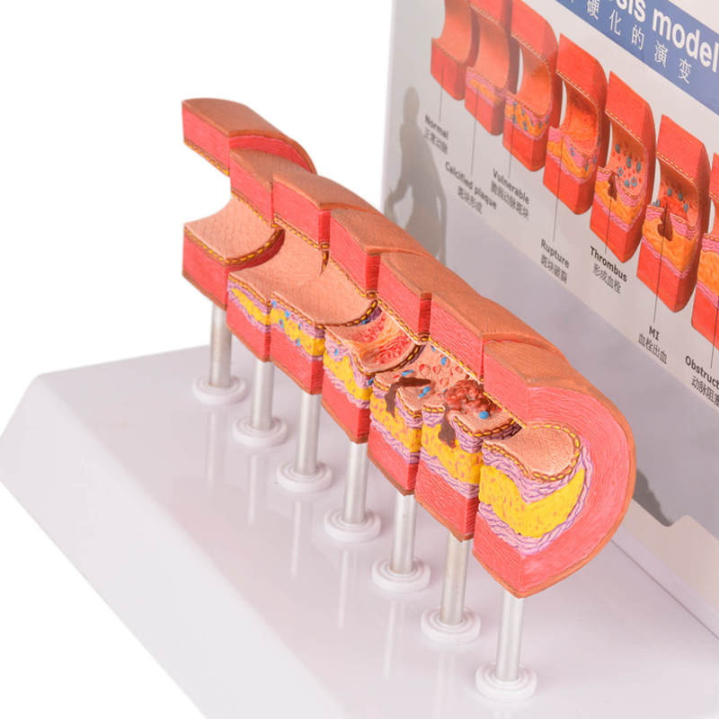Atherosclerosis Evolution Model