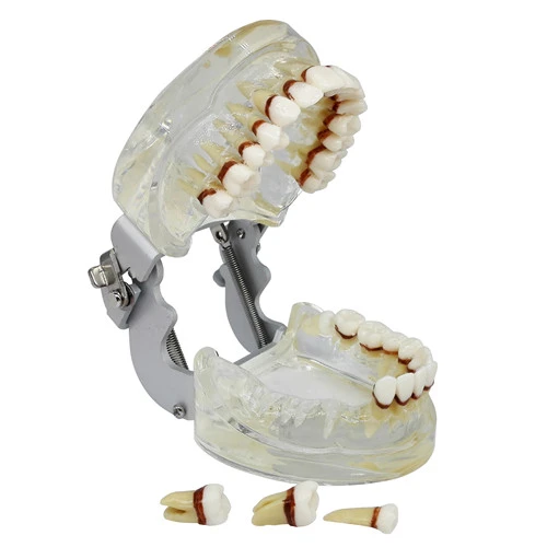 Dental Teeth Model Study Teach Standard Model Gums Removable Teeth ...