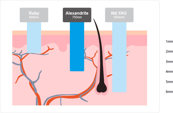 Noblex,Long Pulsed 755nm & 1064nm Alexandrite Laser
