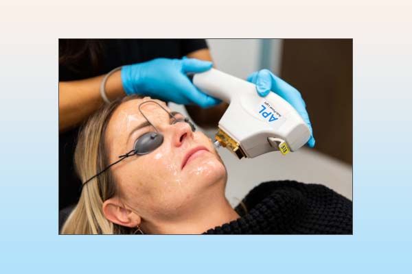 Aurora BBL,Broad Band Light BBL Machine