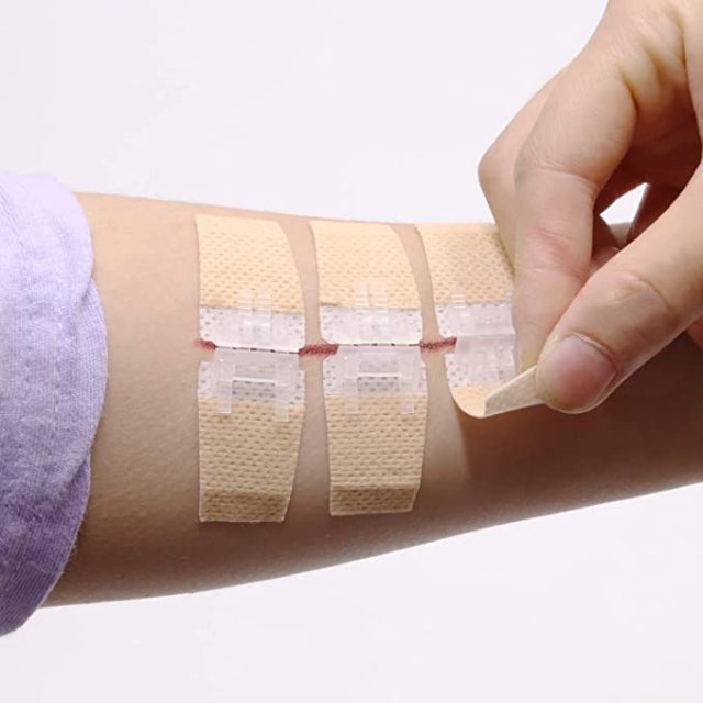 Wound Closure Device/Skin Staplers