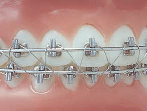 Surgical Brackets
