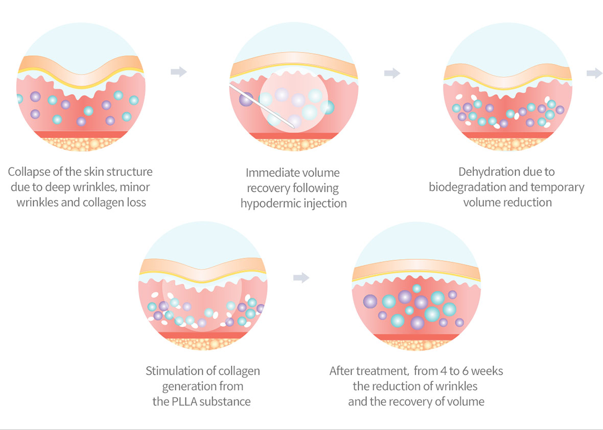 Understanding PLLA: A Comprehensive Guide to Poly-L-Lactic Acid