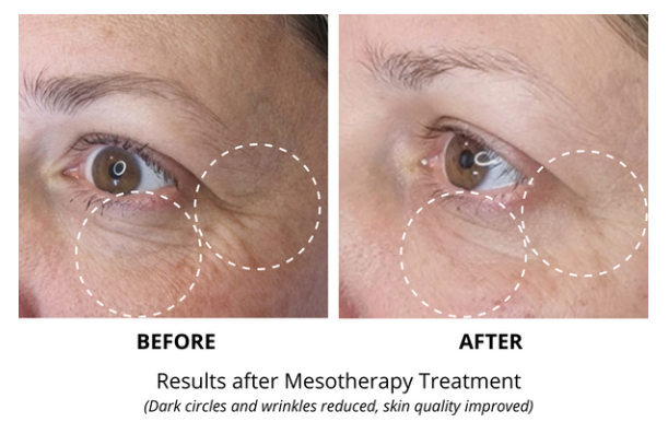 Understanding Mesotherapy: A Comprehensive Overview
