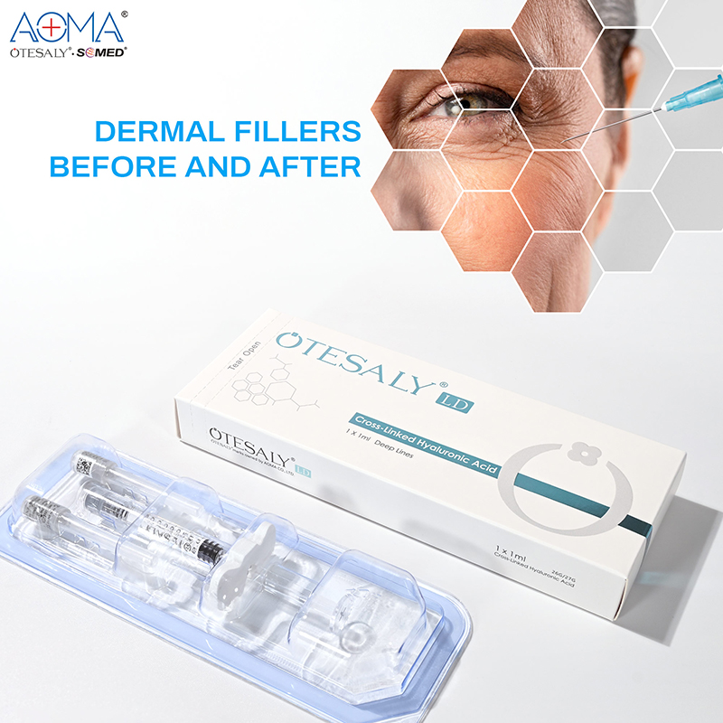 Customized OTESALY DEEP LINES 1ML LIDO Non-Surgical Lift Chin Augmentation