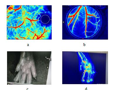 Laser speckle blood flow imager
