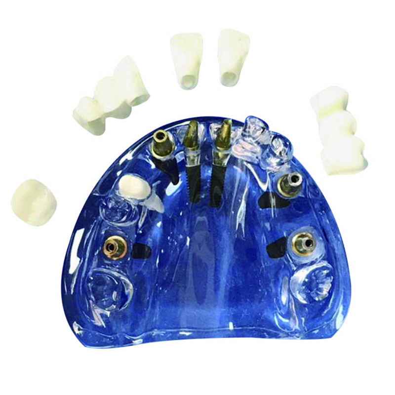 Dental Implant Model Implant and Abutment Demonstration