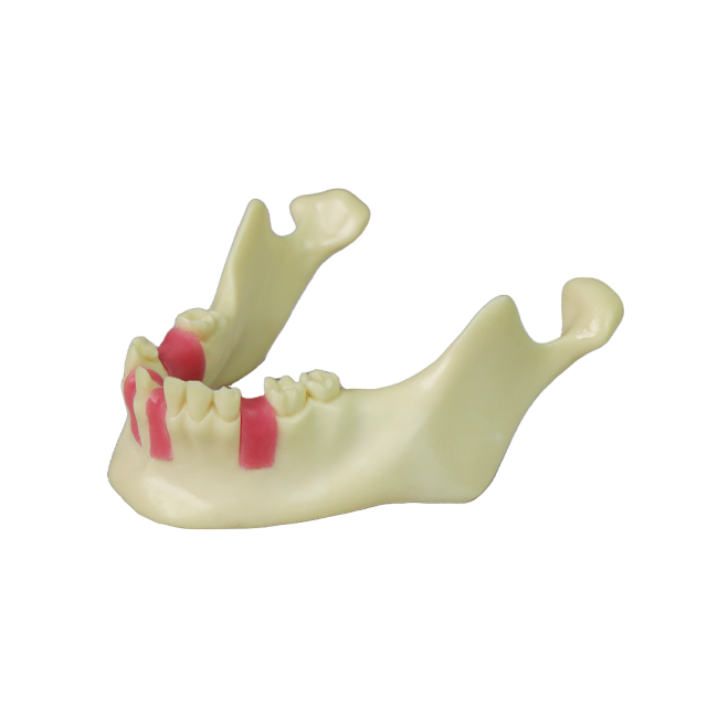 Mandibular Dental Implant Model – Foamed Resin for Implant Practice JG ...