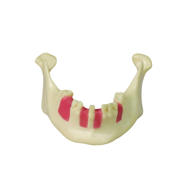 Mandibular Dental Implant Model – Foamed Resin for Implant Practice JG ...