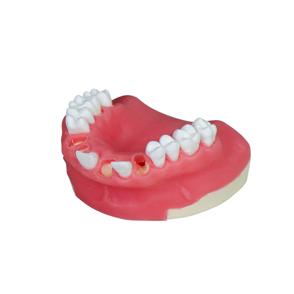 Dental Implant Training Model – Hard Resin with Soft Gum for Implant ...