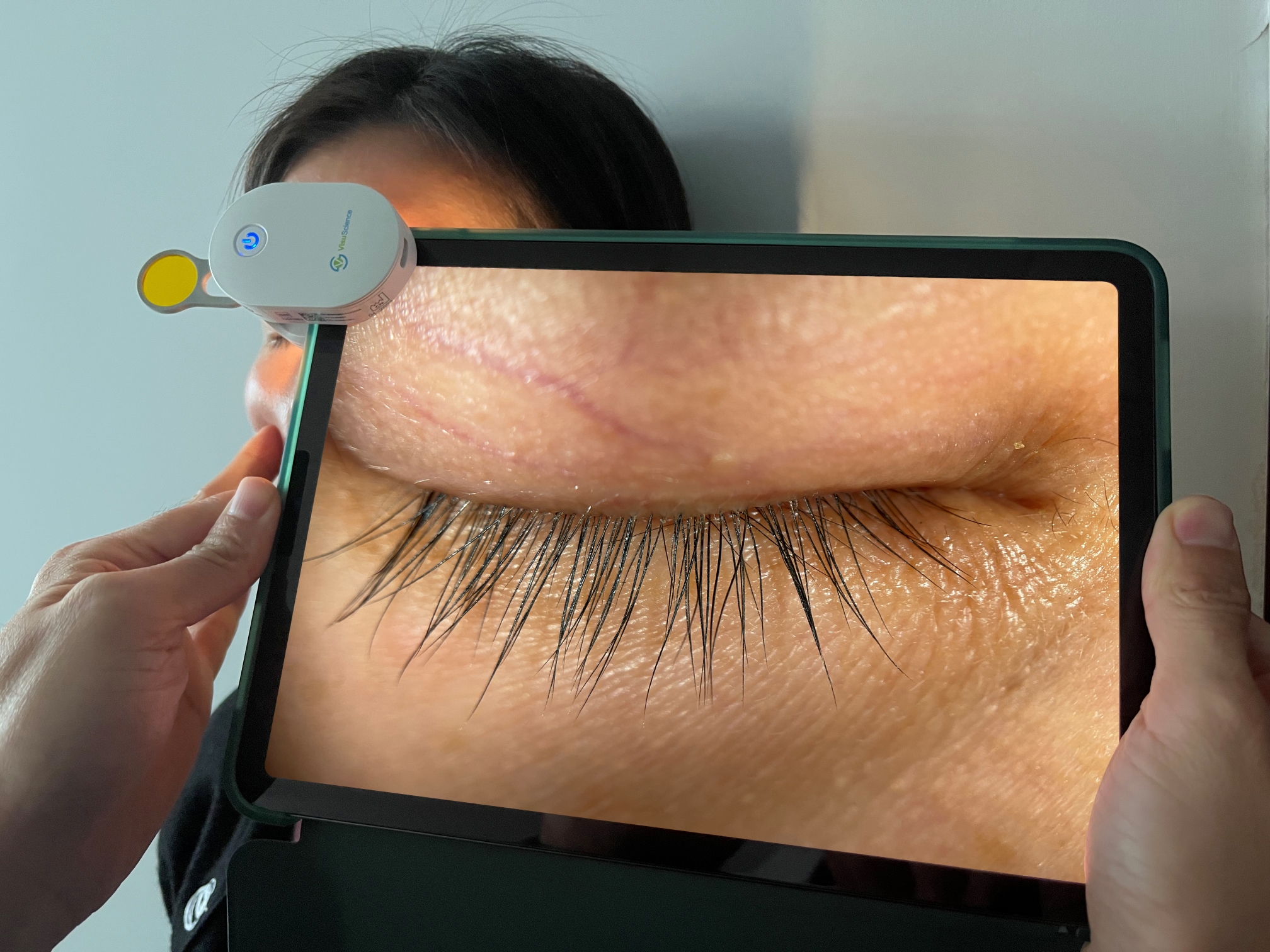 How to check Blepharitis with a tablet and QuikVue eye imaging adaptor