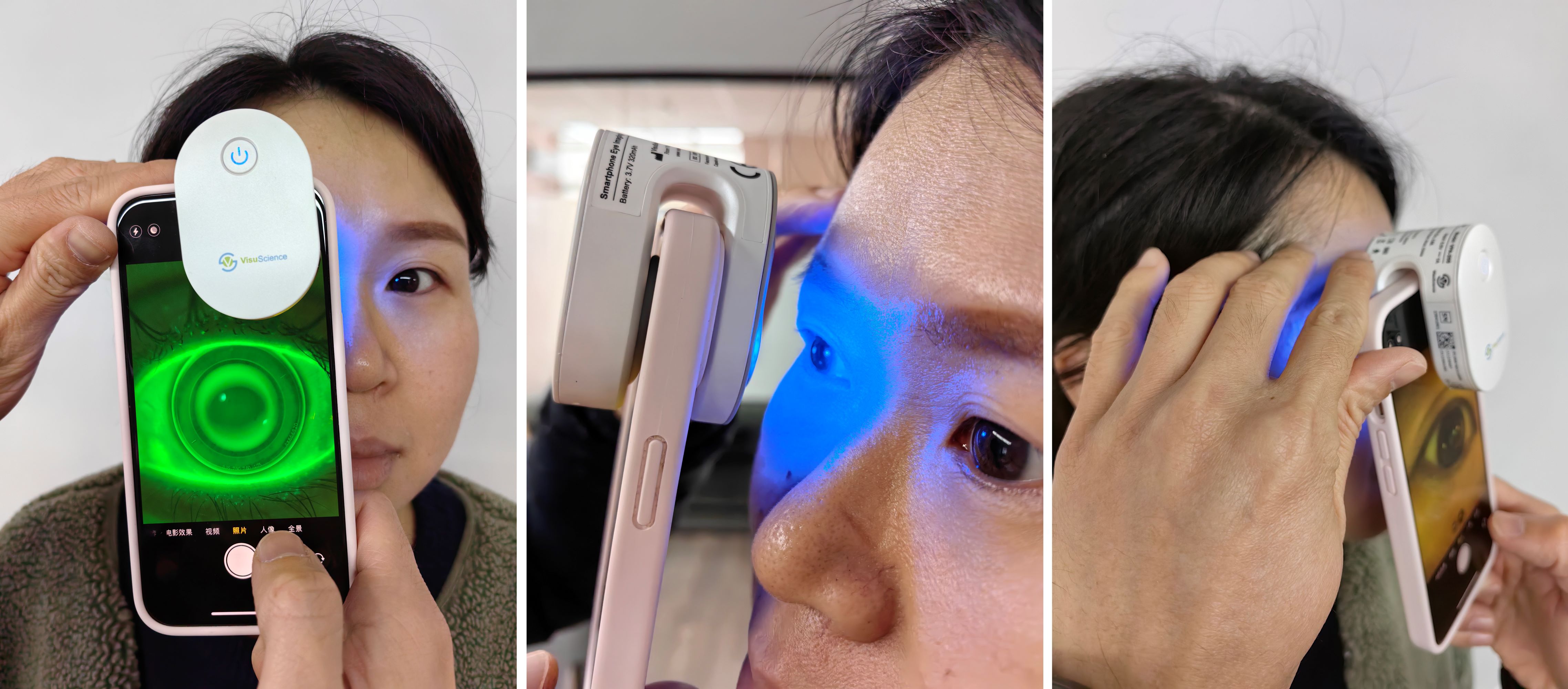 OK Lens Fitting with a QuikVue smartphone eye imaging Adaptor