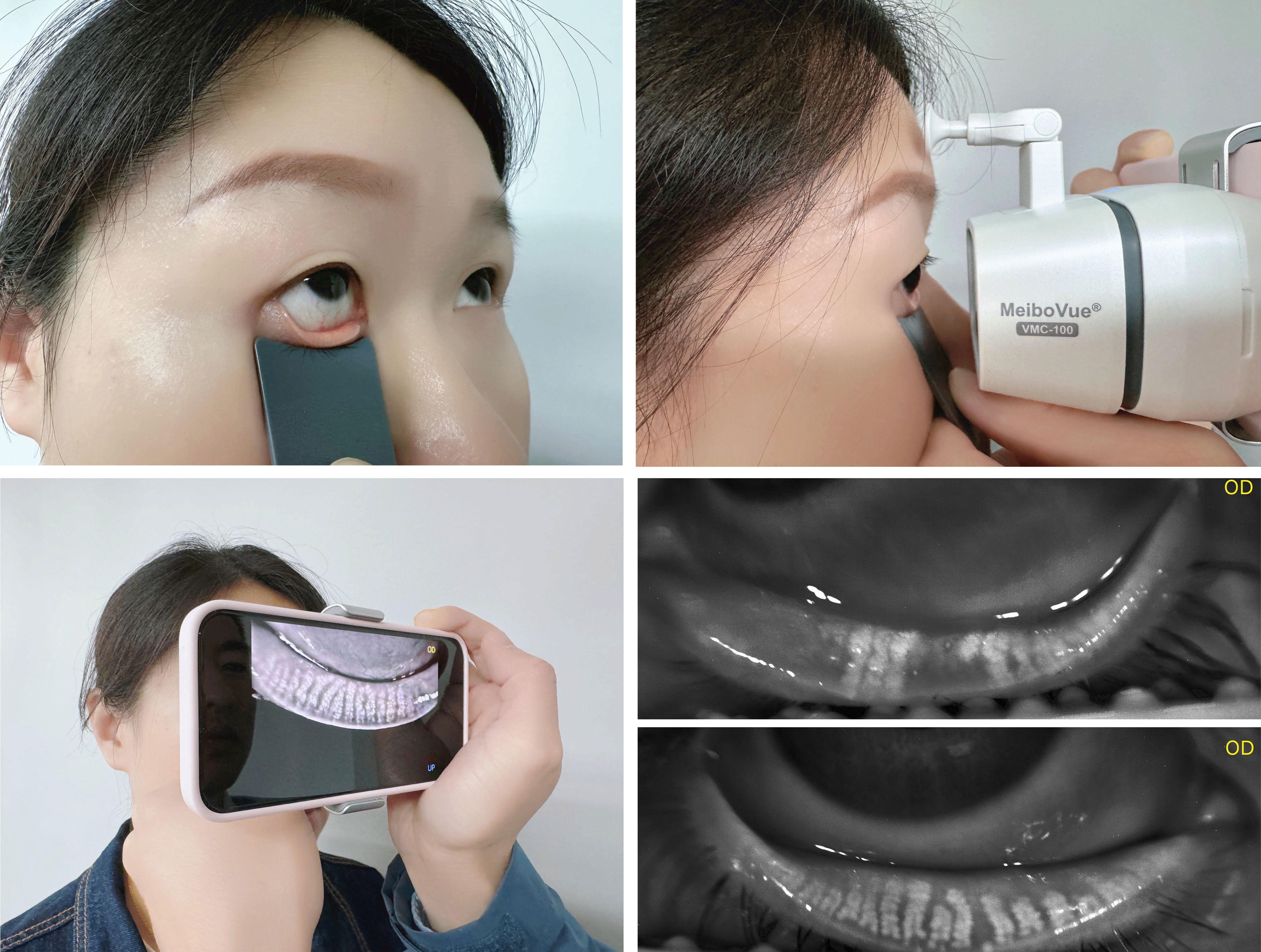 Smartphone Meibographer MeiboVue VMC-100