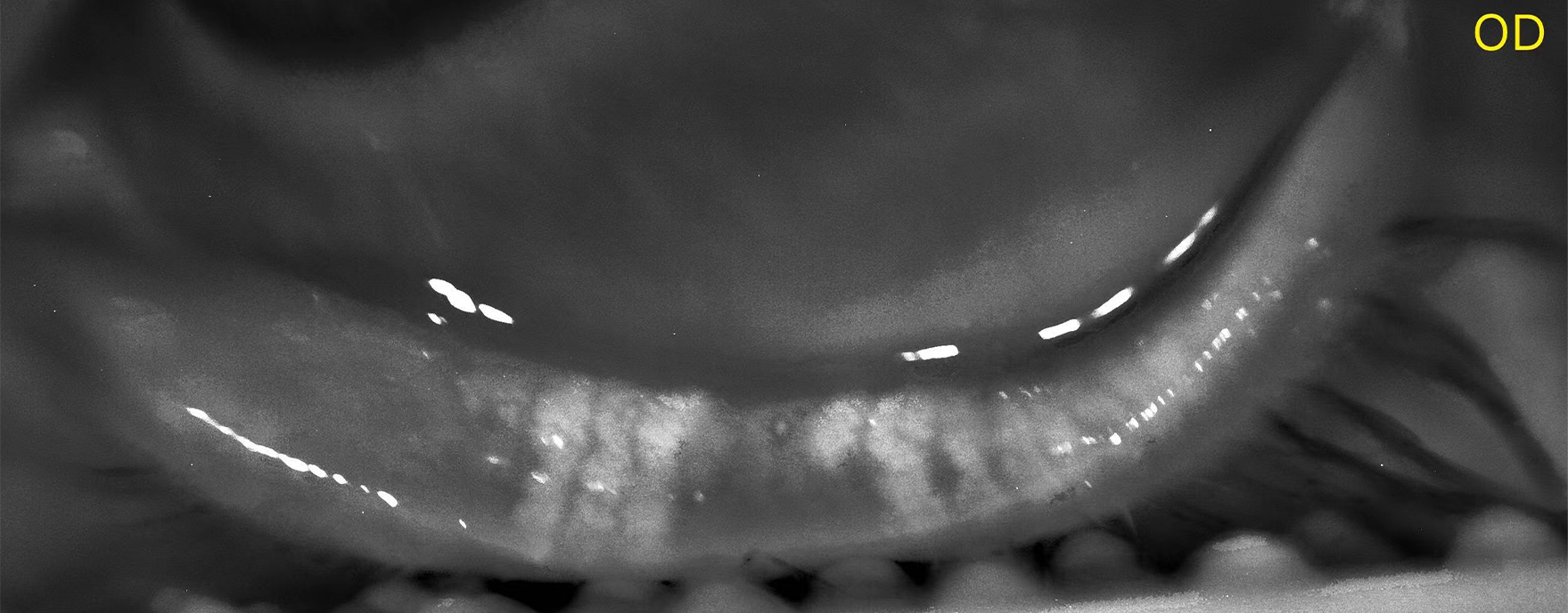 How to Interpret Meibography