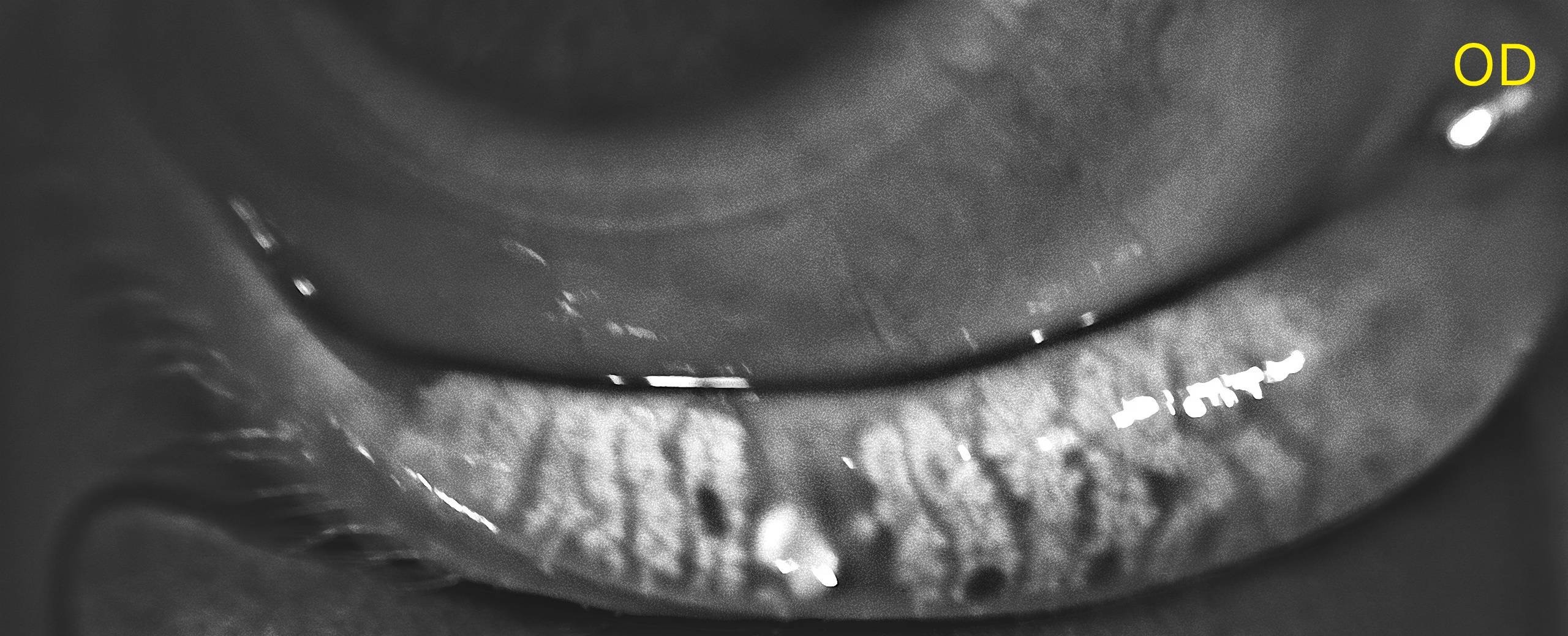 How to Interpret Meibography