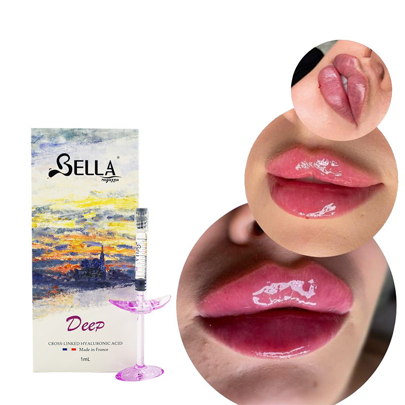 Bella dermal fillers for lip enhancement