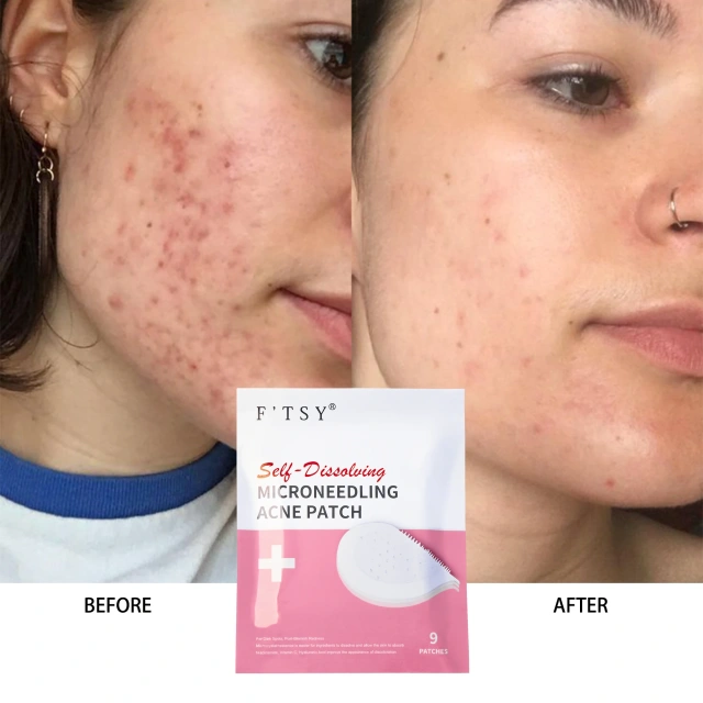 Microneedle Acne Patch – Dark Spot & Pimple Care