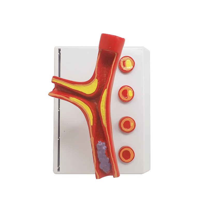 Arteriosclerosis Model, with Cross Section of Artery, 4 Part