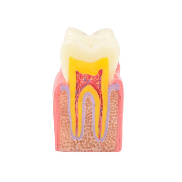 Dental Teeth Decay Model, 6 Times Caries, Comparative Study for Dentist