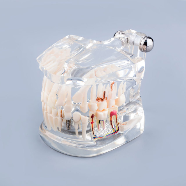 Transparent Disease Teeth Model Missing Gum for Patient & Student Education