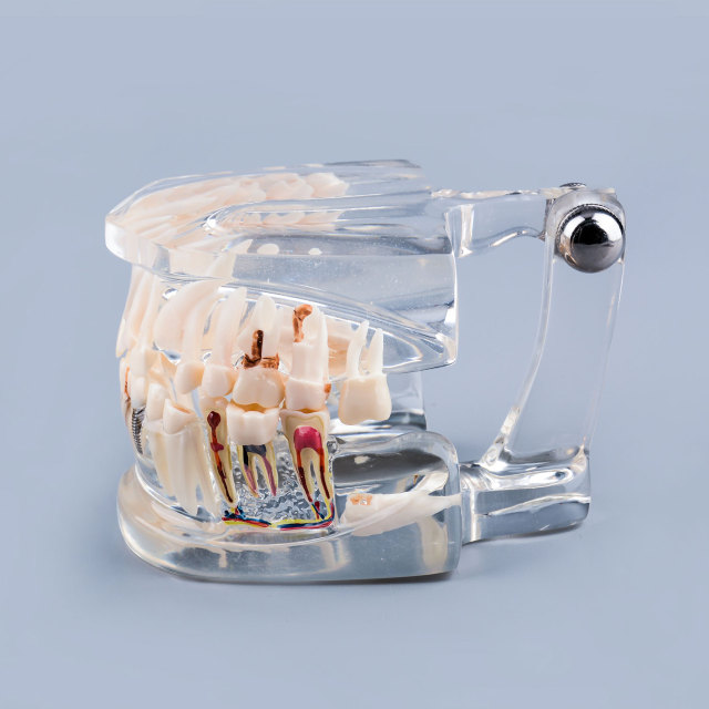 Transparent Disease Teeth Model Missing Gum for Patient & Student Education