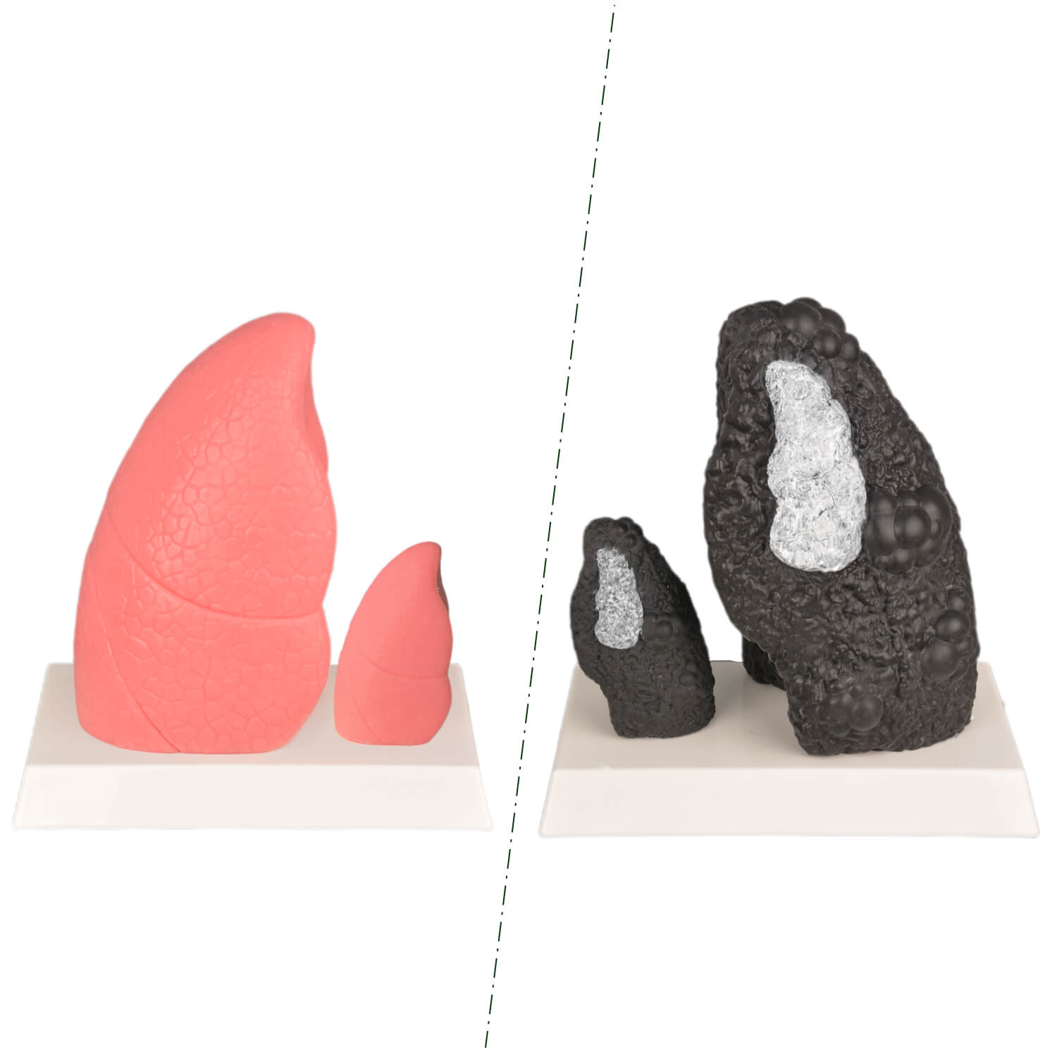 Healthy and Smokers Lung Model, Small and Large Size