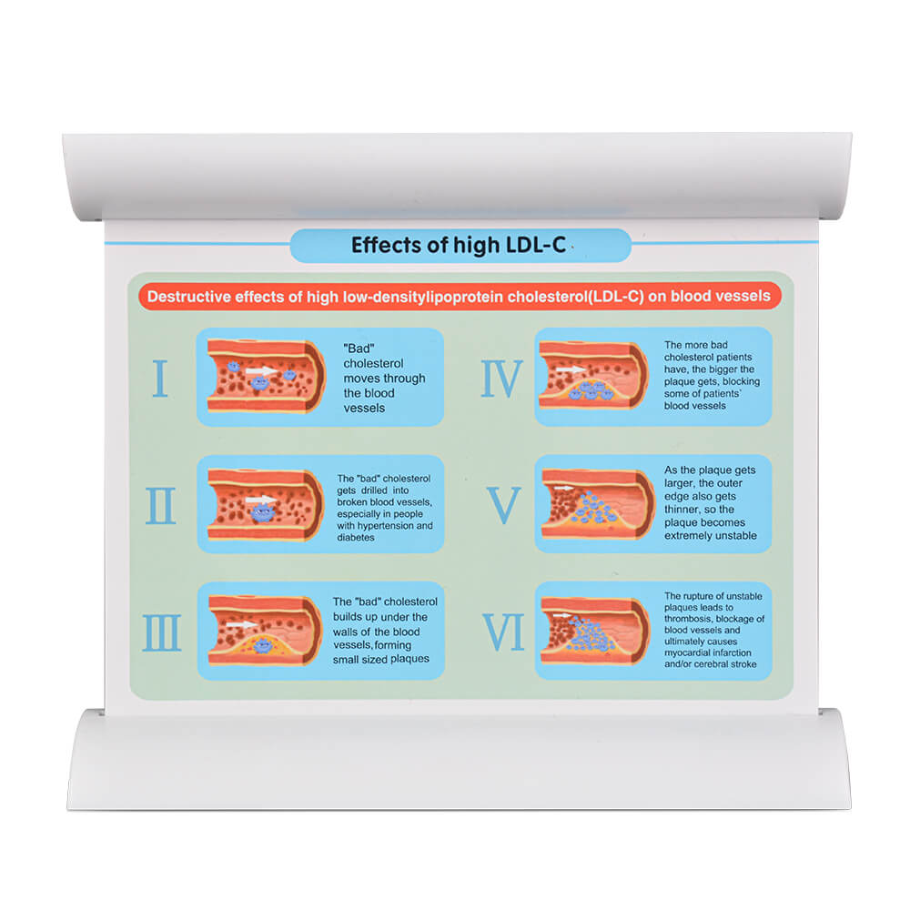 Four Stage Blood Vessel Blockage Model for Customization
