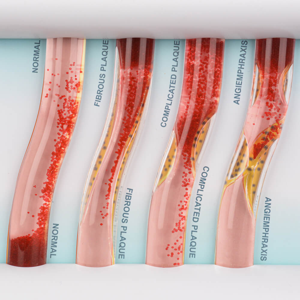 Four Stage Blood Vessel Blockage Model for Customization