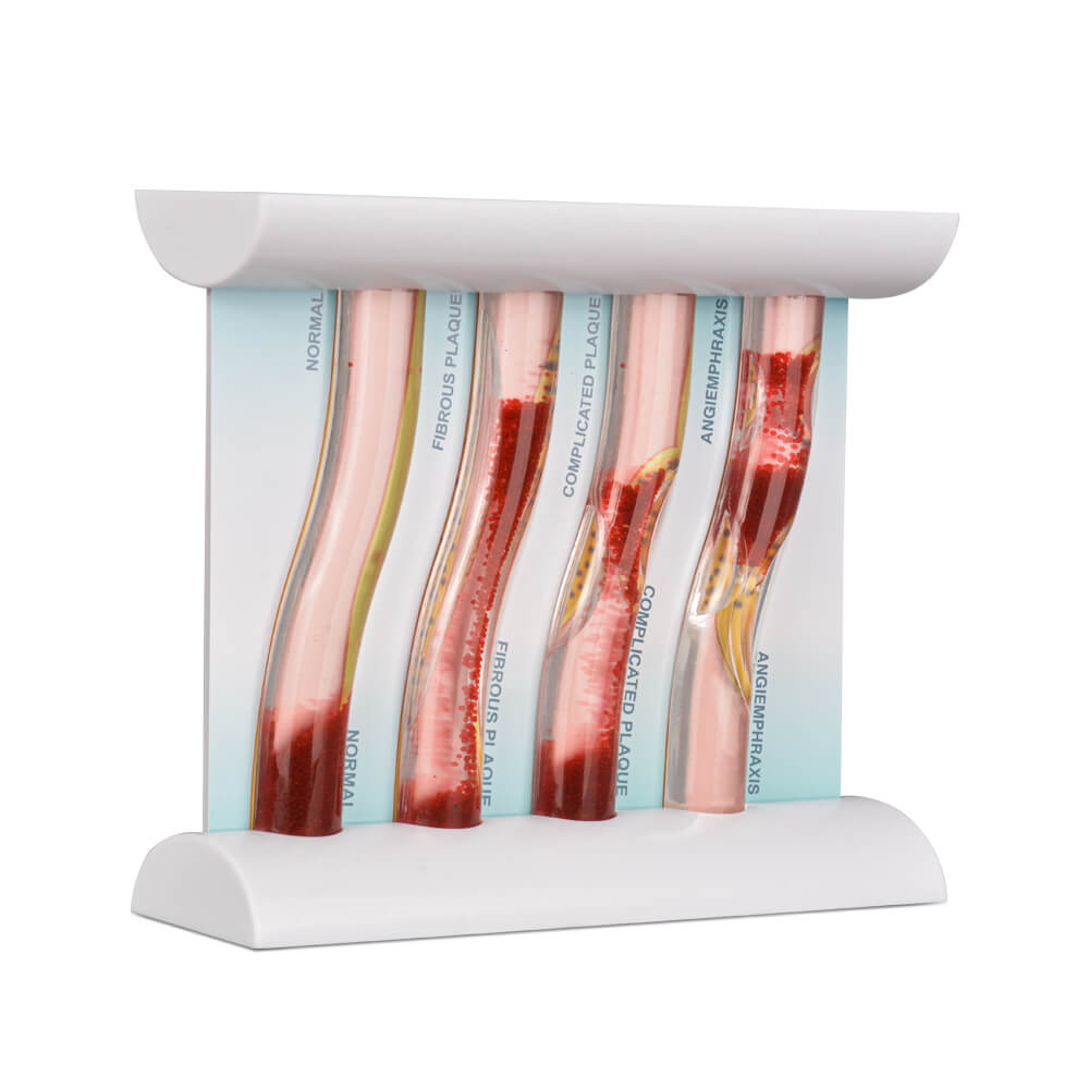 Four Stage Blood Vessel Blockage Model for Customization