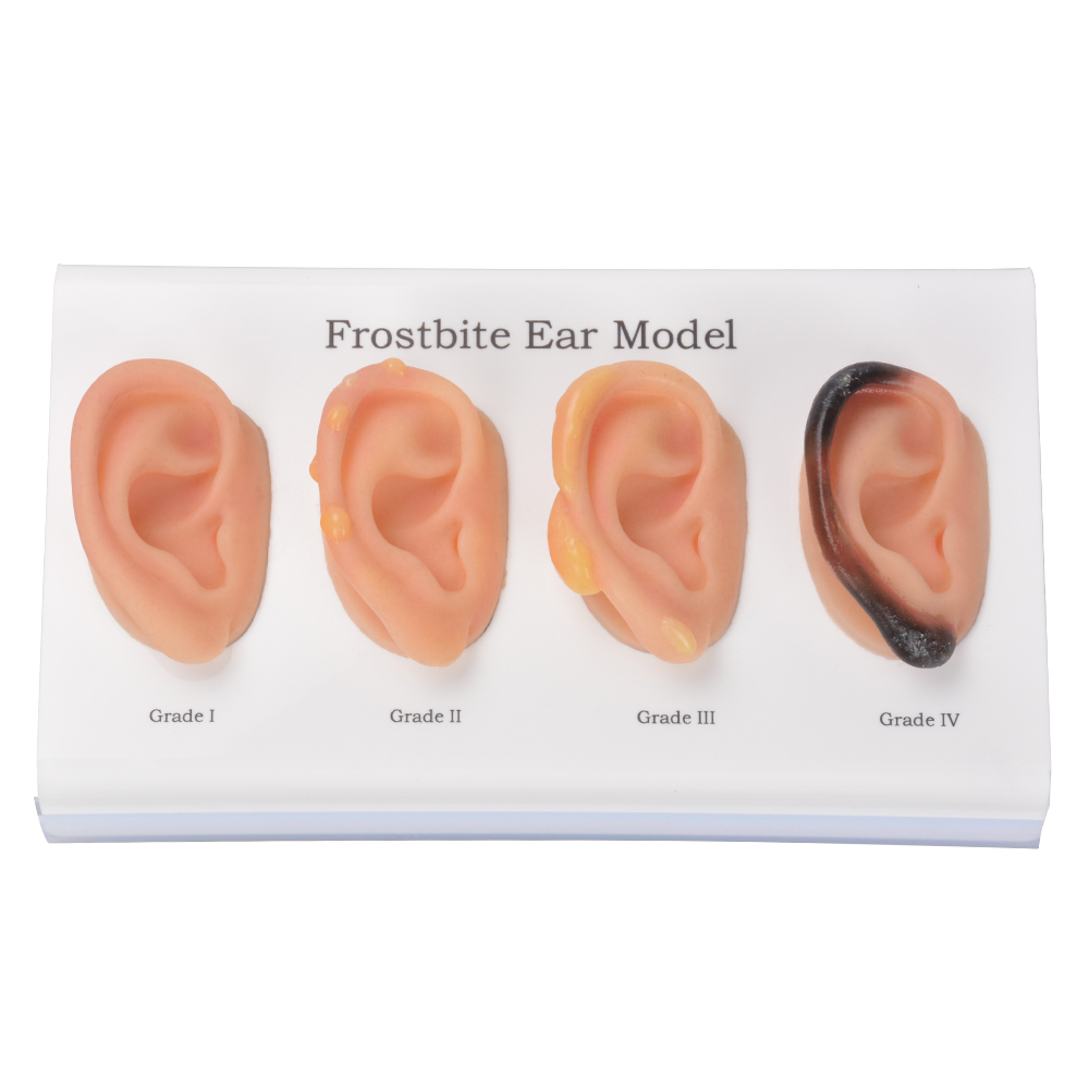 Frostbite Ear Model (Grade1-4)