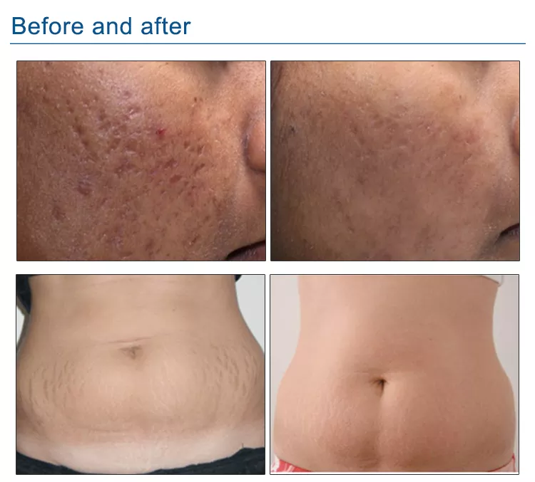 microneedling fractional rf microneedle machine