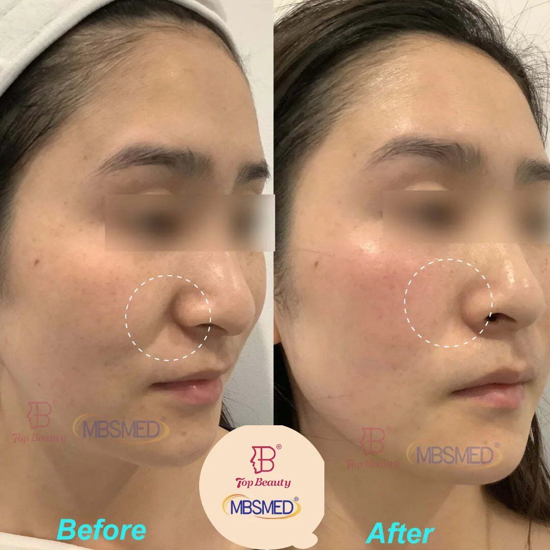 Thermage vs HIFU A Guide to the Best Skin Tightening Solution