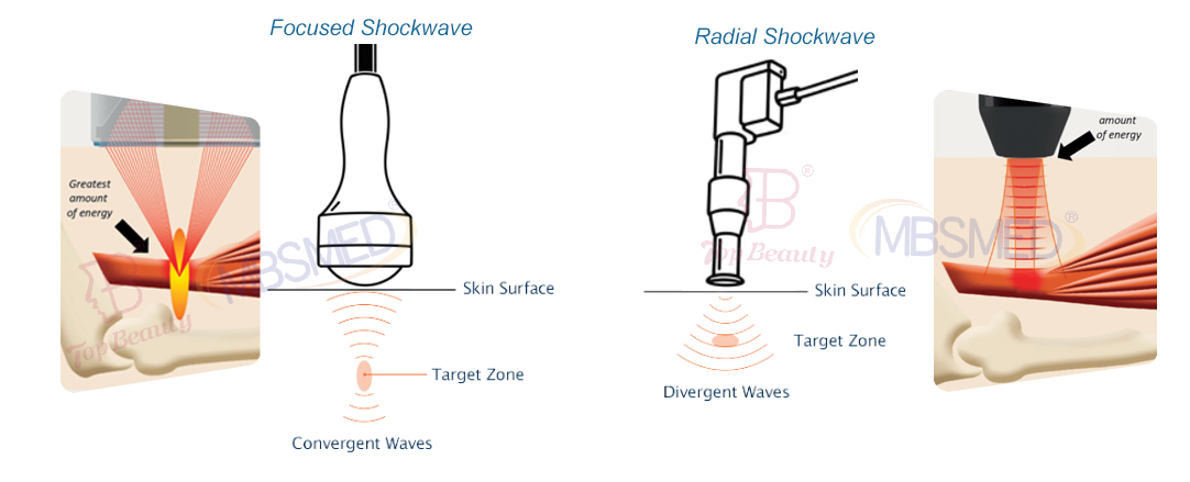 Focused vs. Radial Shockwave Therapy: Key Differences Explained